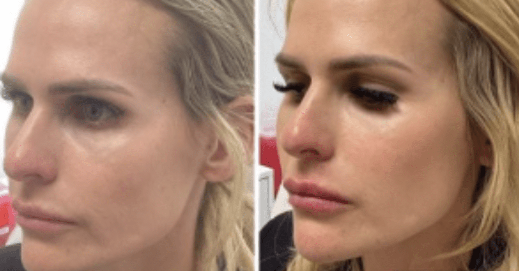 Step-by-Step Guide: What to Expect During Your Sculptra Injectable ...