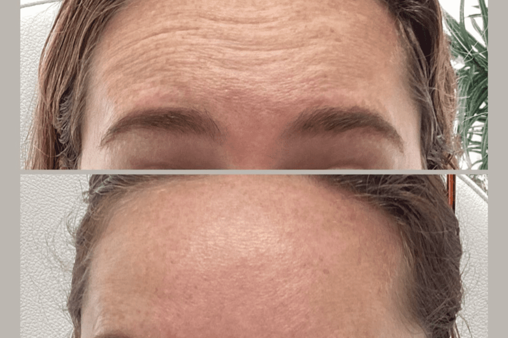 How to Find the Best Botox and Choose the Right Clinic | House of Aesthetix